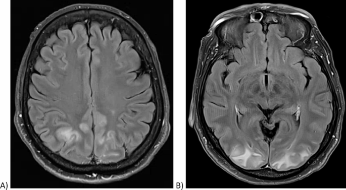 PRES-like MRI findings in sporadic Creutzfeldt-Jakob disease: a case ...
