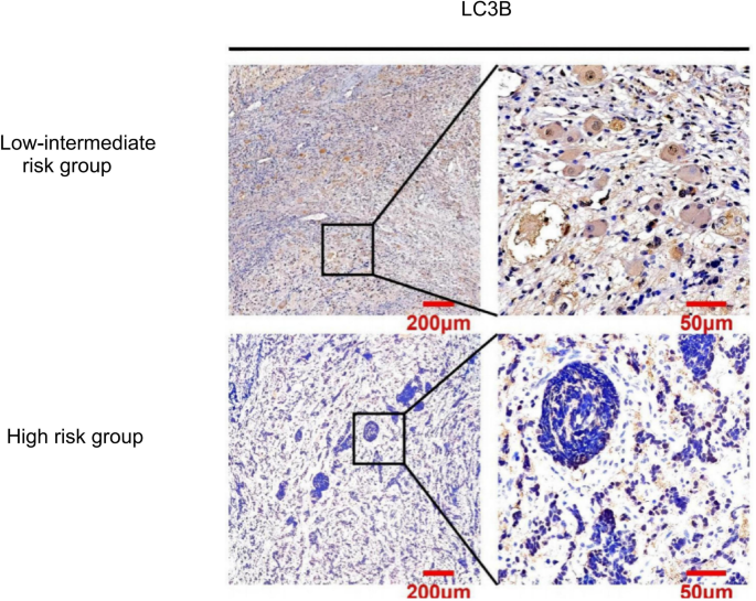 LC3B as a potential serum biomarker for screening high-risk ...