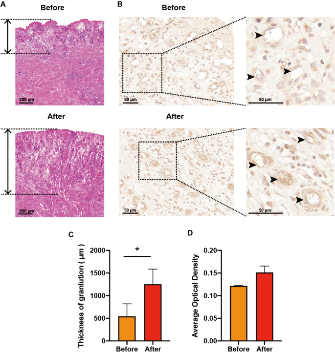 The Effect of Platelet Fibrin Plasma (PFP) on Postoperative Refractory ...