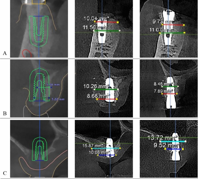 Reducing Healing Period with DDM/rhBMP-2 Grafting for Early Loading in ...