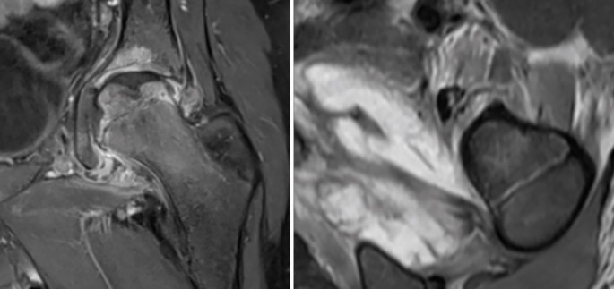 Coxitis fugax richtig erkennen | Orthopädie & Rheuma