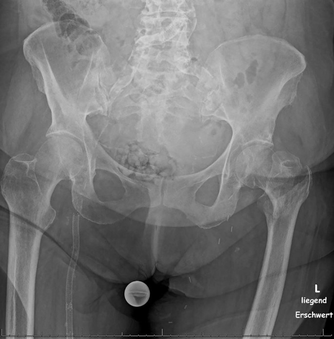 Proximal femoral fracture | MMW - Fortschritte der Medizin | Springer ...