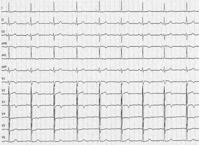 Red Flag im EKG - hätten Sie's gesehen? | MMW - Fortschritte der Medizin