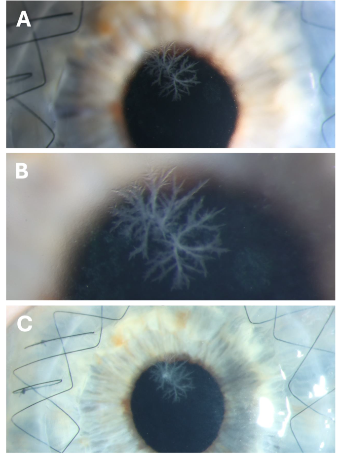 Corneal snowflake – a case of infectious crystalline keratopathy after ...