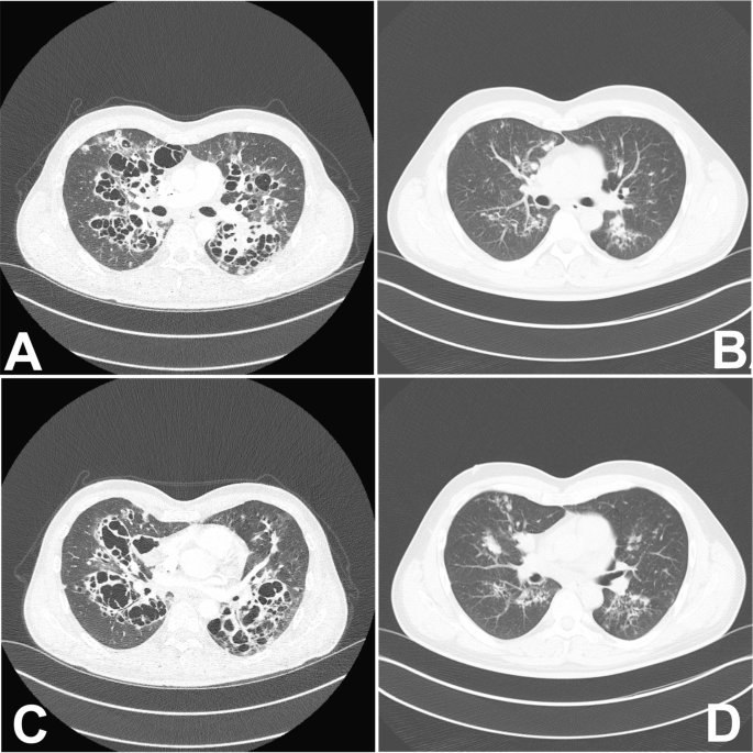 Infection image: cystic pneumocystis jirovecii pneumonia – forgotten ...