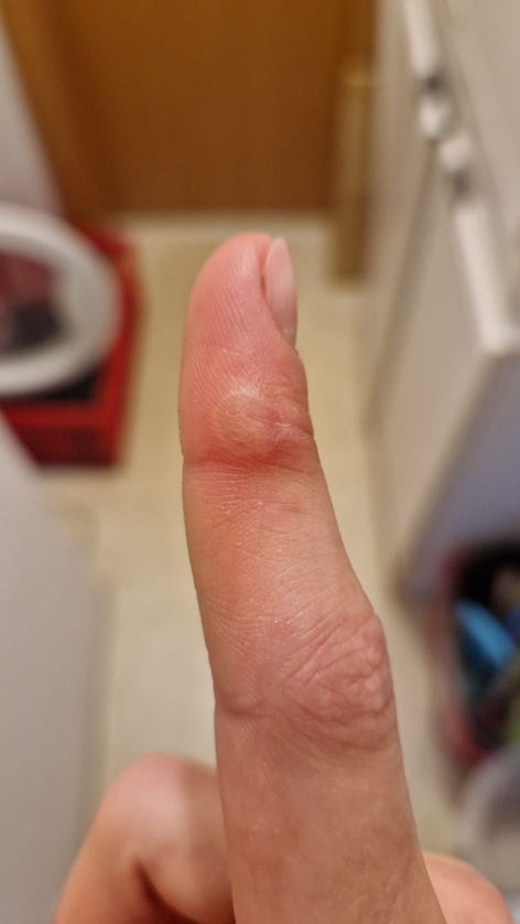 Images in infectious diseases: milker’s nodule with erythema multiforme ...