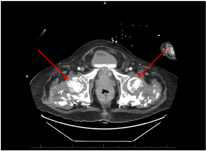 Candida auris candidemia, septic arthritis, and vertebral osteomyelitis ...