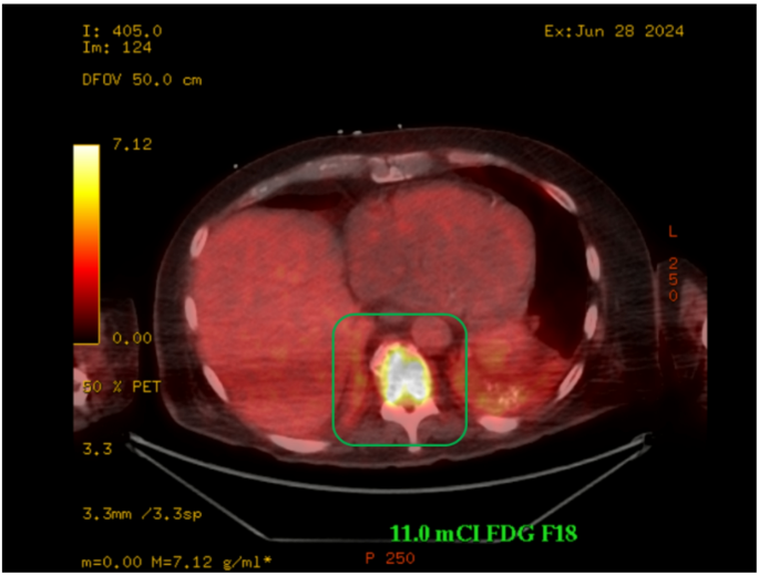 Candida auris candidemia, septic arthritis, and vertebral osteomyelitis ...