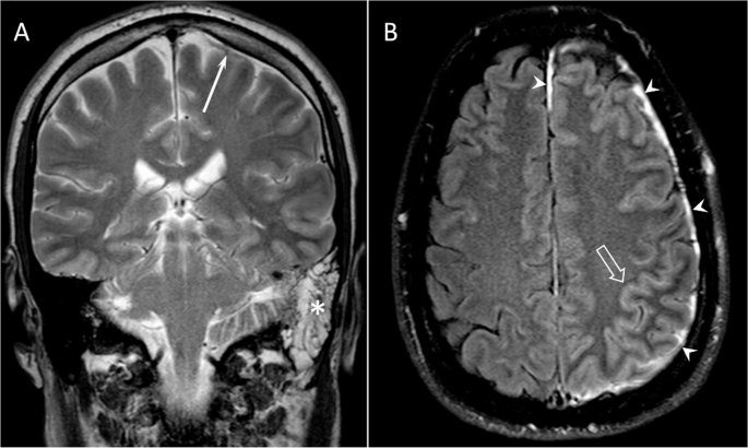 Otogenic meningitis in children | Infection | Springer Nature Link