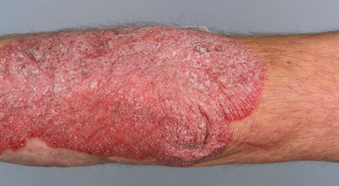 Adipositas ist bei Psoriasis mehr als nur eine Komorbidität | hautnah ...