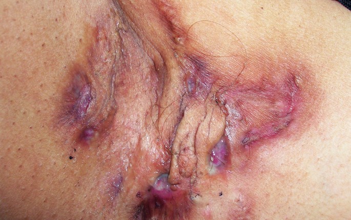 Stadiengerechte Therapie der Hidradenitis suppurativa/Acne inversa ...