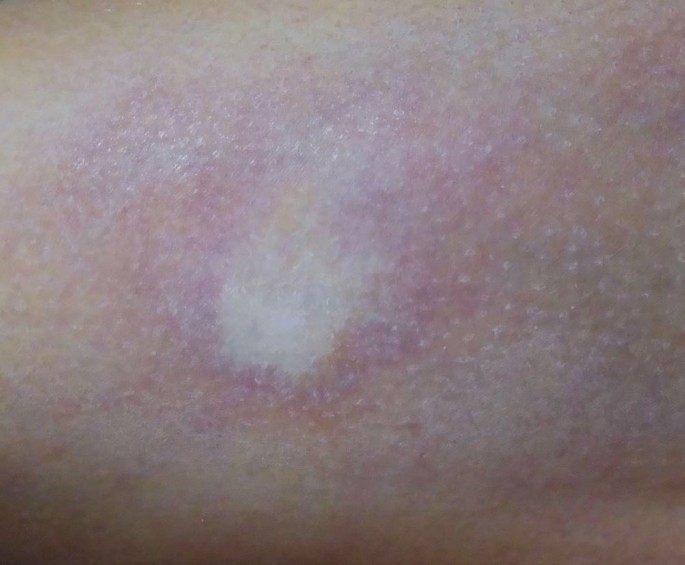 Morphea: Die vielen Gesichter der umschriebenen Sklerodermie | Pädiatrie