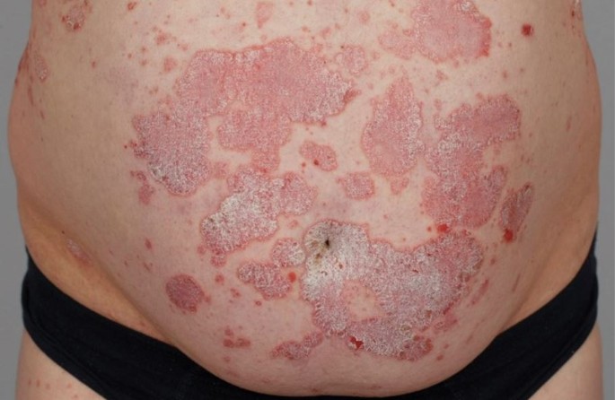 Zusammenhang zwischen Psoriasis und Adipositas | CardioVasc