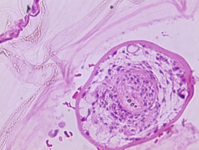 Parasitenalarm im Gallengang - eine ungewöhnliche Cholestase | Gastro-News