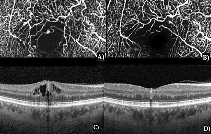 Novel Finding of Retinal Aneurysmal Alterations in Patients Undergoing ...