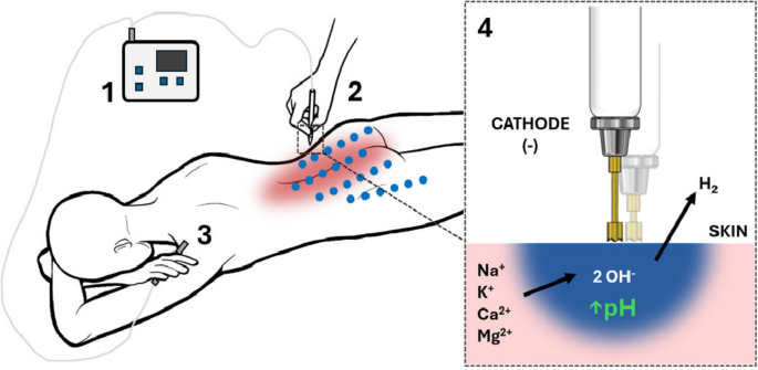 Efficacy of Rebox Electrotherapy in Pain Management: A Randomized ...