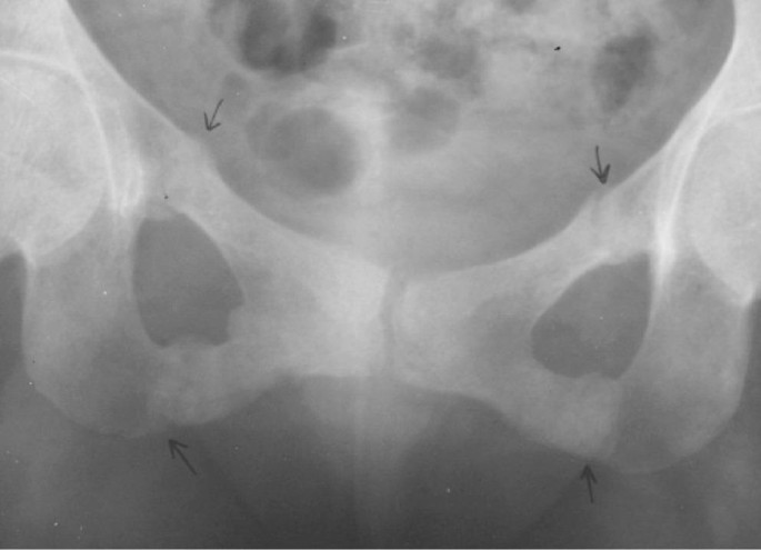 Renal Osteodystrophy Pathology Outlines