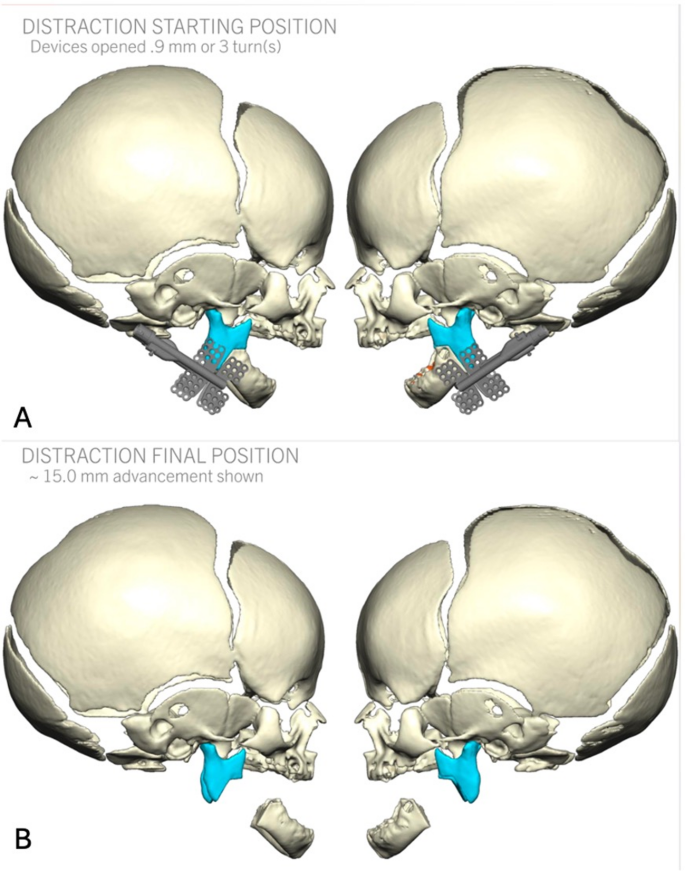 Advances in Mandibular Distraction Osteogenesis | Current ...