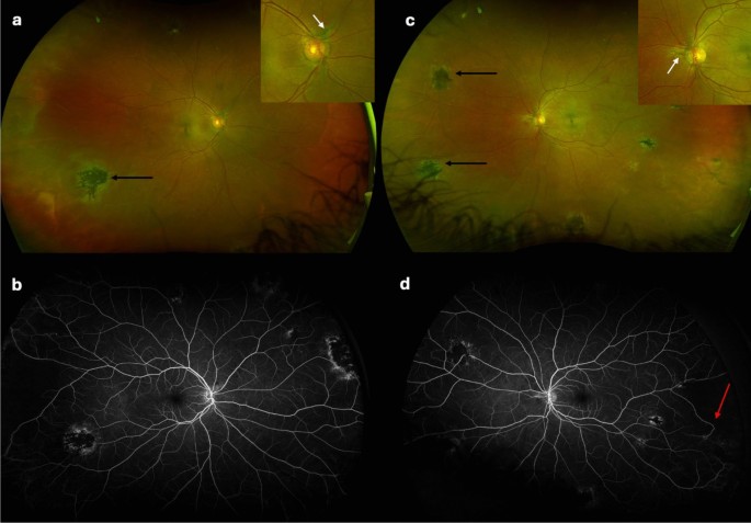 How I Manage Sickle Cell Retinopathy | Current Surgery Reports