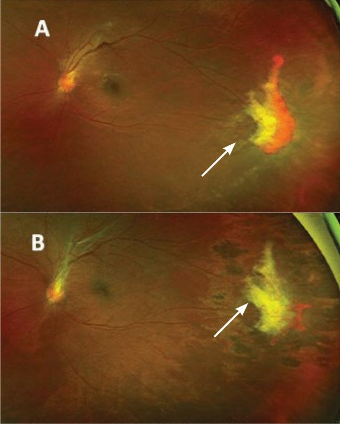 How I Manage Sickle Cell Retinopathy | Current Surgery Reports