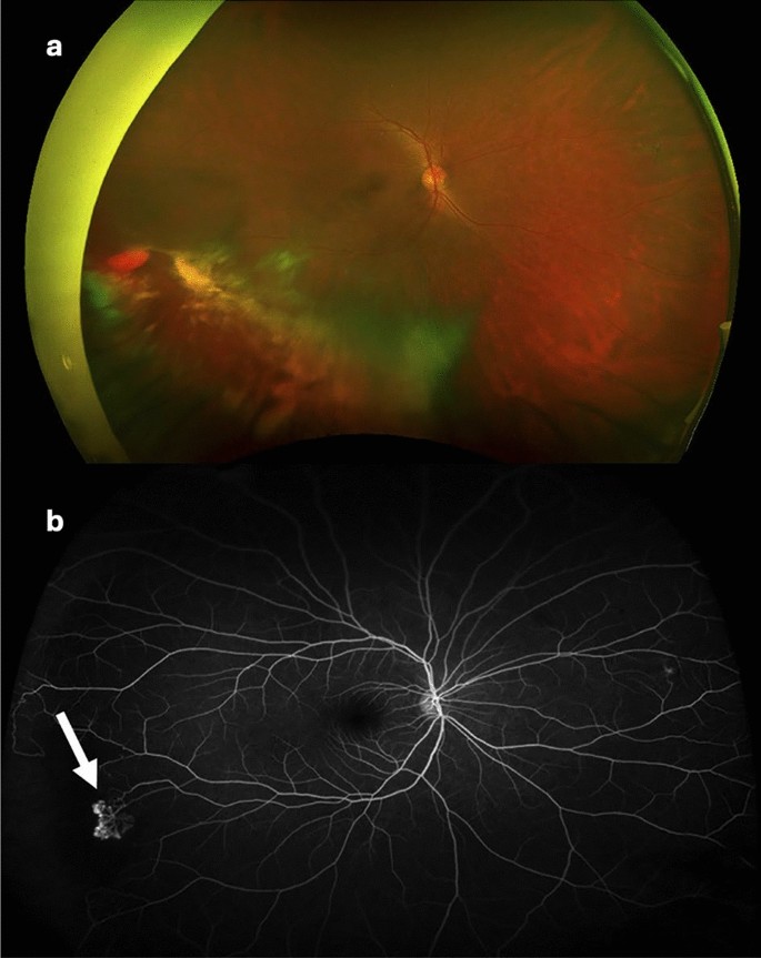 How I Manage Sickle Cell Retinopathy | Current Surgery Reports