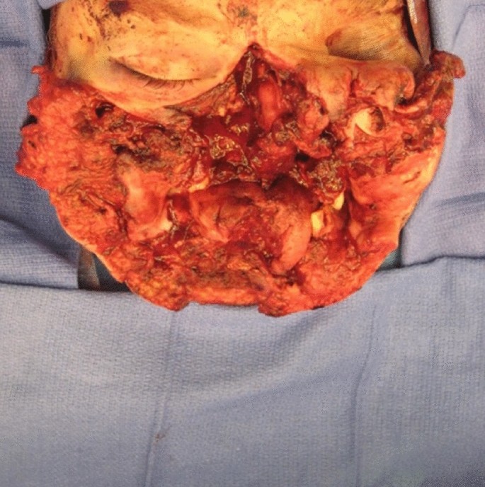 A Decadal Review of Reconstruction of Maxillofacial Gunshot Injuries ...