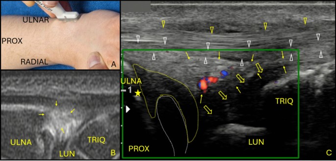 Evaluation and Management of Triangular Fibrocartilage Complex (TFCC ...