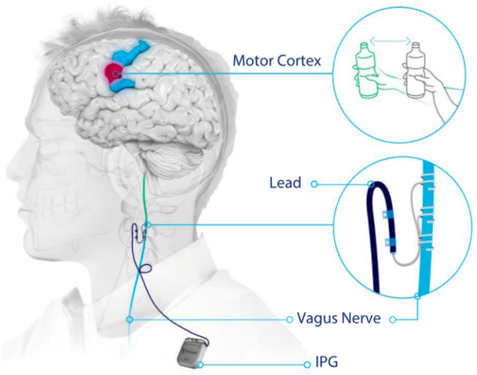 Recent Advances in Vagus Nerve Stimulation for Stroke Rehabilitation ...