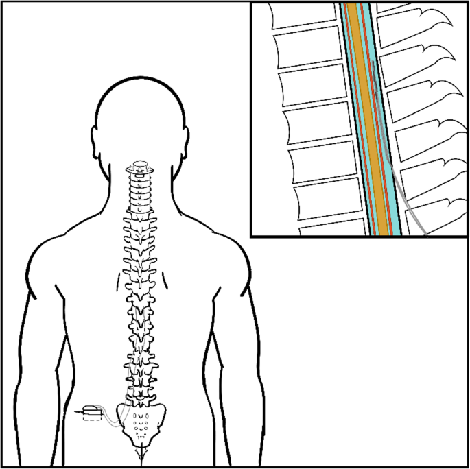 Spinal Cord Stimulation for Functional Restoration in Patients with ...