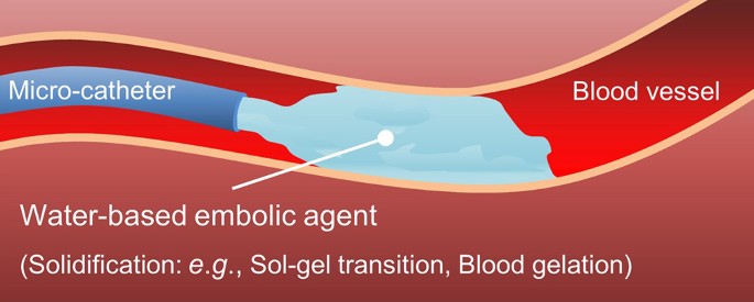 Recent Progress on Water-based Liquid Embolic Agents in Endovascular ...