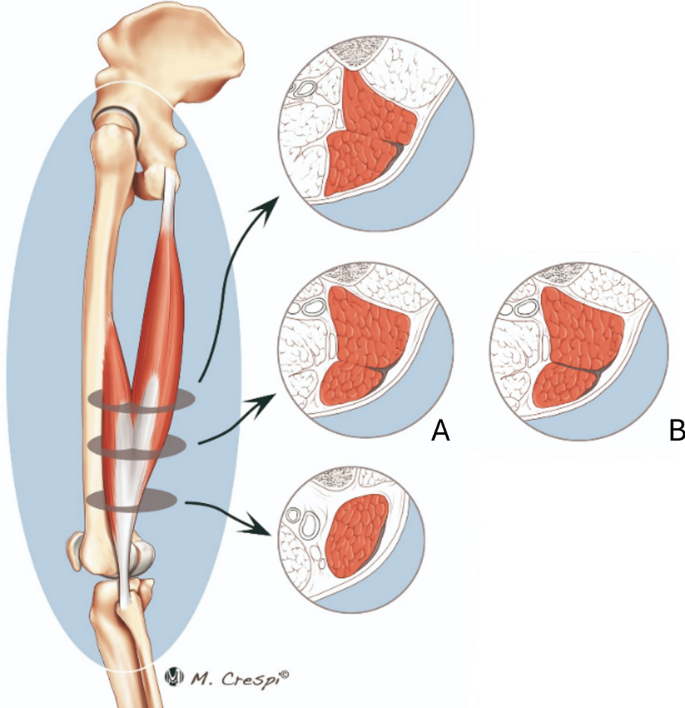 A New Anatomical Approach to T-Junction Hamstring Injuries | Sports ...