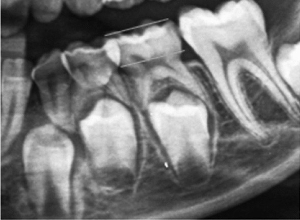 Root resorption pattern and root length of mandibular primary molars in ...