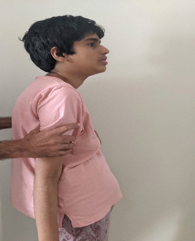Clinical insights into dental care for siblings with Jamuar syndrome: a ...