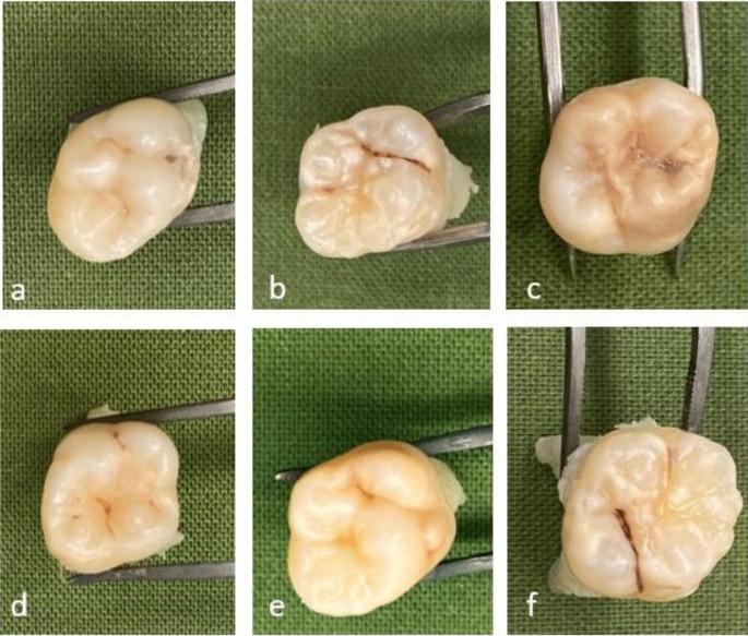 Penetration depth and enamel hardness effects of resin infiltrate and ...