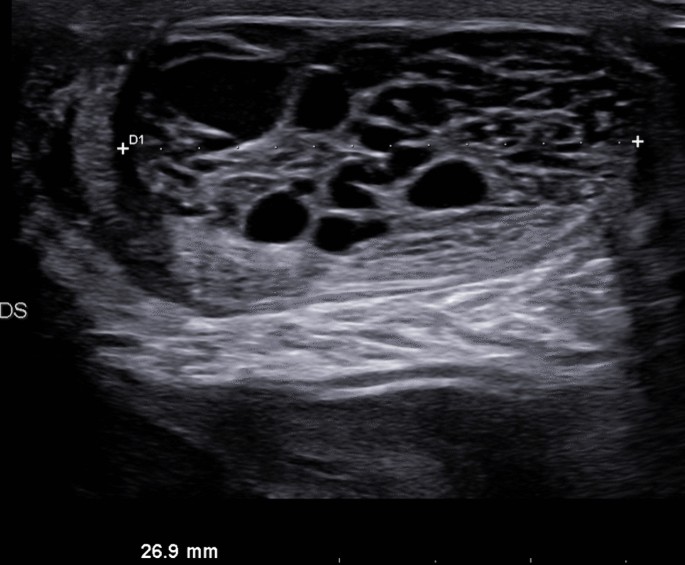 Testicular juvenile granulosa cell tumor: a case report | Journal of ...