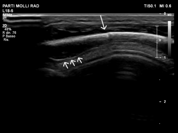 Identifying skull fractures after head trauma in infants with ...