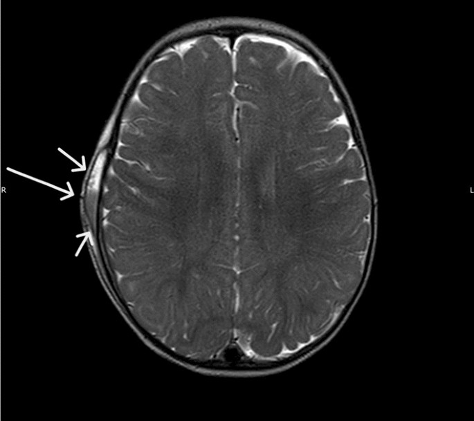 Identifying skull fractures after head trauma in infants with ...