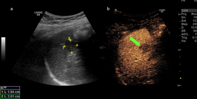Percutaneous radiofrequency ablation of ovarian cancer metastasis in ...