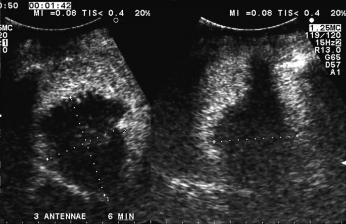Salvage radiofrequency ablation for microwave ablation treated ...