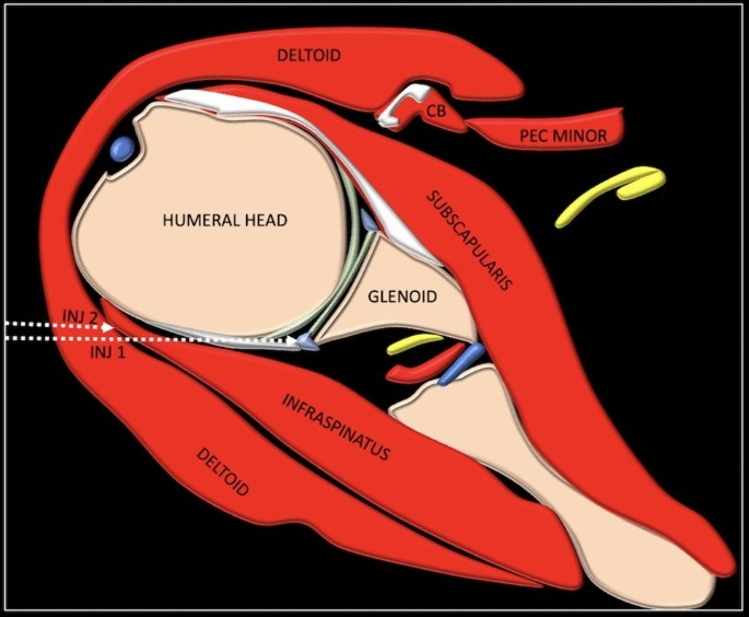 GIBPS technique—a novel sequential technique of performing shoulder ...