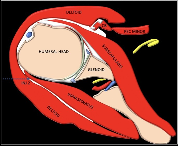 GIBPS technique—a novel sequential technique of performing shoulder ...