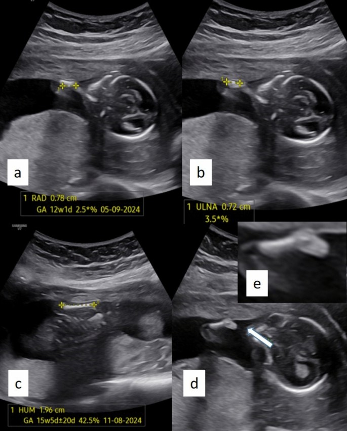 Antenatal unilateral upper limb acromesomelic dysplasia | Journal of ...