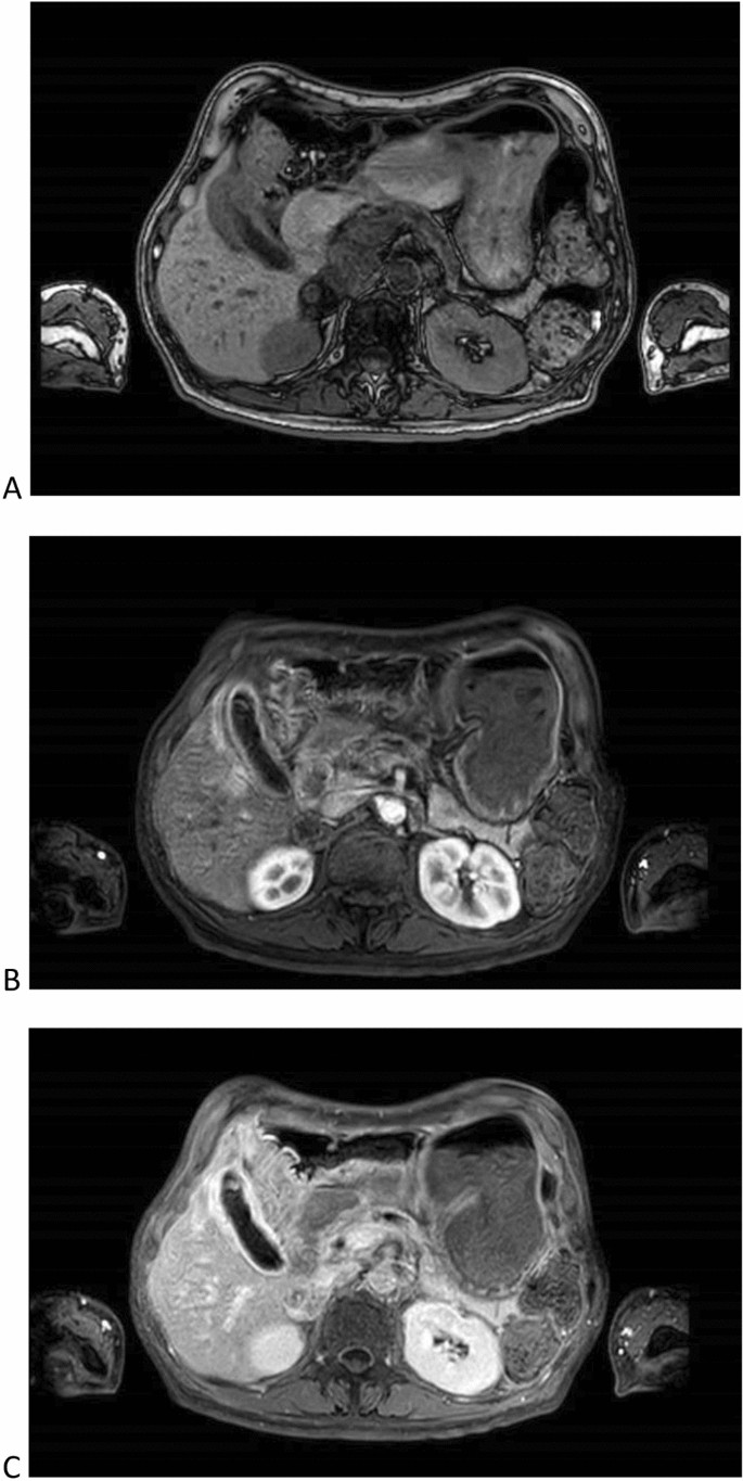 Focal acute cholecystitis misdiagnosed as gallbladder carcinoma ...