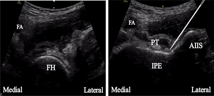 Pericapsular Nerve Group block in the emergency department for hip ...
