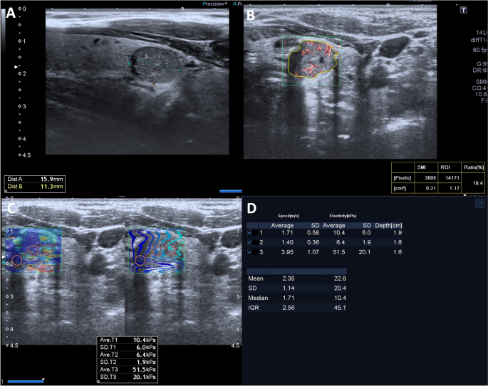 Evaluating the clinical impact of integrating superb microvascular ...