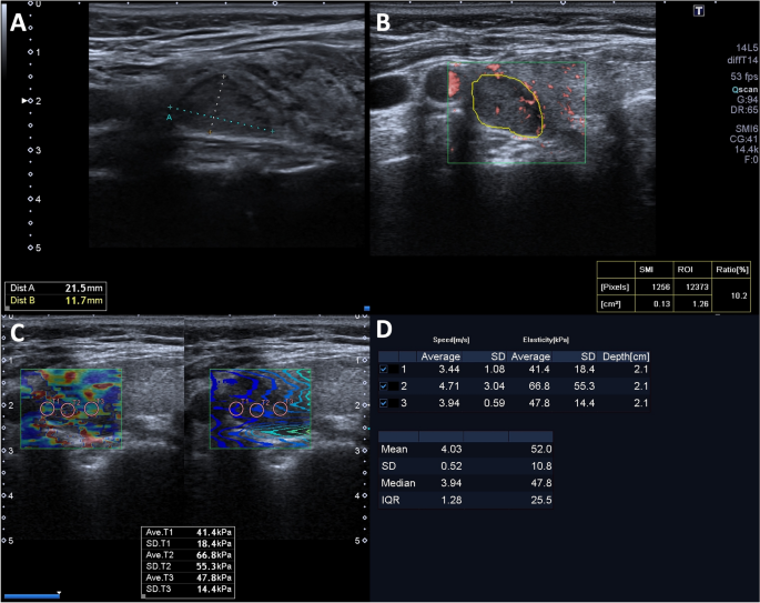 Evaluating the clinical impact of integrating superb microvascular ...