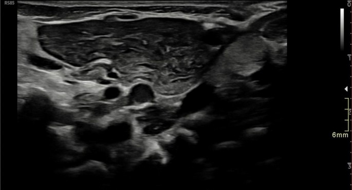 Atypical cervical ectopic thymus located in the submandibular space: a ...