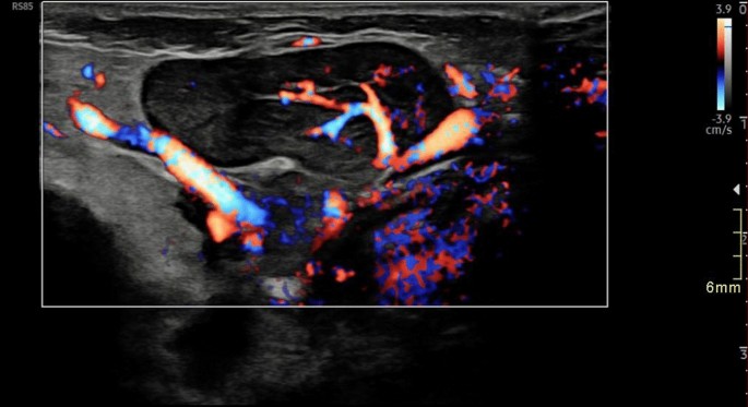 Atypical cervical ectopic thymus located in the submandibular space: a ...