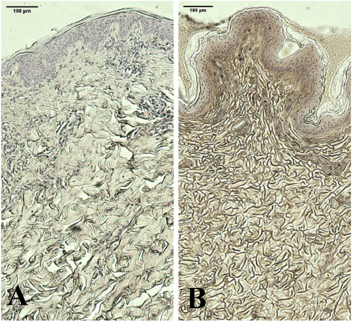 Radiofrequency and targeted ultrasound enhance natural hyaluronic ...