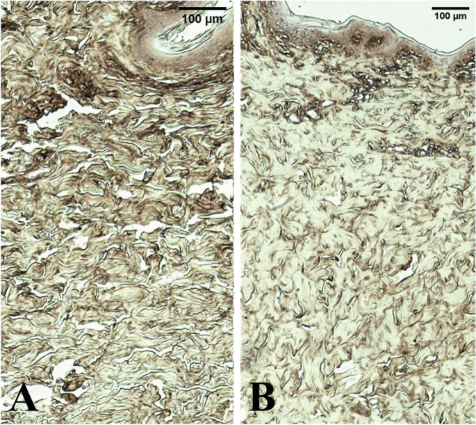 Radiofrequency and targeted ultrasound enhance natural hyaluronic ...